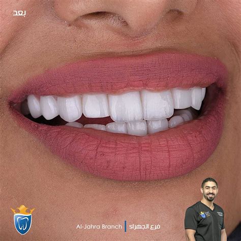 قبل وبعد Before And After مركز تيجان افضل عيادة اسنان في الكويت
