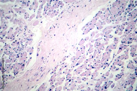 skeletal muscle atrophy photomicrograph showing decreased fiber size