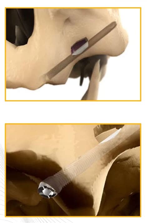 Dental Implant Neodent Zigomatic Cm Zygomatic Implants