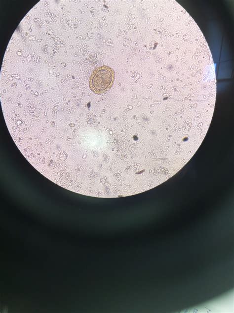 Ascaris Lumbricoides Stool Microscopy Specimen Stool Stool