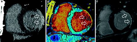 Imaging Of Myocardial Viability Experimental And Clinical Evidence Radiology Key