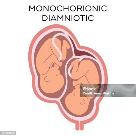 Monochorionic Diamniotic Twins Vector Illustration Stock Illustration