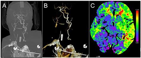Schematic Illustration Of The Arterial Cannulation And The Cerebral