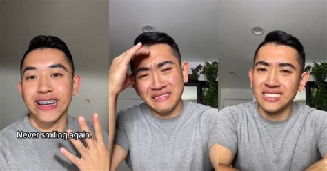 Al Quitarse Los Brackets Este Joven No Pudo Evitar Llorar ¡ahora Cree Que Se Ve “feo” Sin Ellos