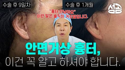 안면거상 흉터 아직도😮 걱정하고 계신가요 리프팅 안면거상안면거상회복기간 Youtube