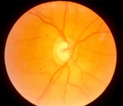Glucoma Photos Flashcards Quizlet