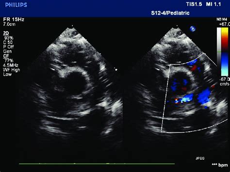 Postoperative Color Doppler Echocardiogram Showing Flows In The Download Scientific Diagram