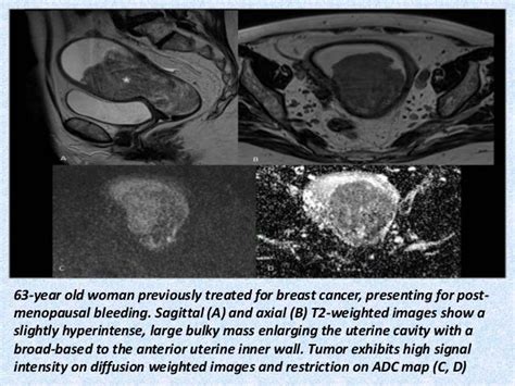 Presentation1pptx Radiological Imaging Of Uterine Lesions