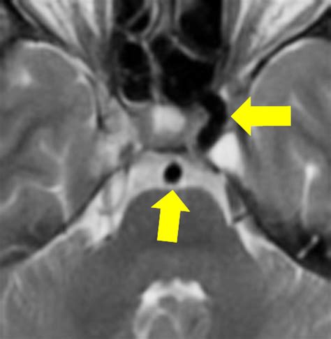Basilar Artery Mri