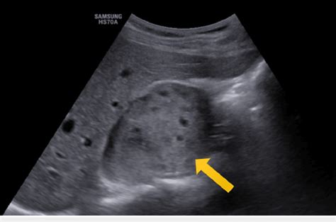 On B Mode Ultrasound An Iso Hyperechoic Mass In The Right Suprarenal