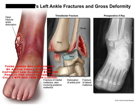 Open Ankle Dislocation