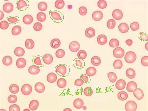 無脾症で見られる末梢血塗抹標本の所見は？ 〜howell Jolly小体の画像〜【97b44】 コウメイ塾