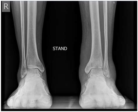 Ap Right And Left Ankle Radiograph Showing Soft Tissue Swelling Around