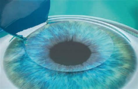 Laser Presbyopia Correction Nobel Medical Group
