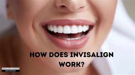How Does Invisalign Work Princess Center Dentistry