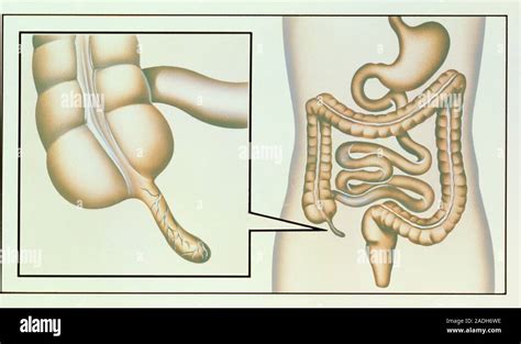 Inflamed Appendix Illustration Of The Intestines With A Close Up Showing An Inflamed Appendix