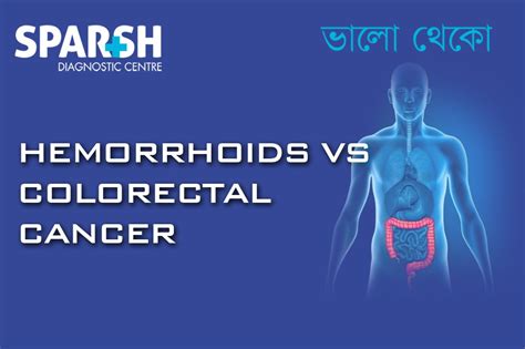Hemorrhoids Vs Colorectal Cancer Understanding The Differences