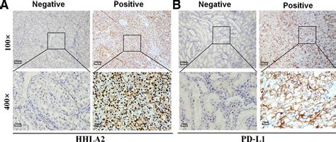HHLA2 And PD L1 Expression In CcRCC Tissue Samples Representative