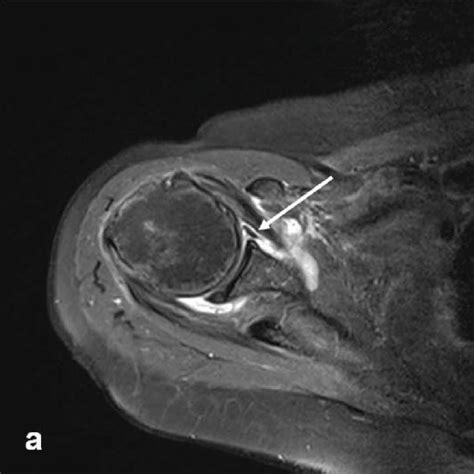 A Transverse A T2 Weighted Mri View Shows A Bankart Lesion White