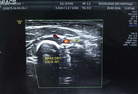 Image Of The Doppler Showing The Humeral Pedicle Without Abnormalities Download Scientific