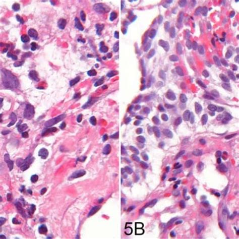 Postoperative Spindle Cell Nodule The Submucosal Nodule Consists Of