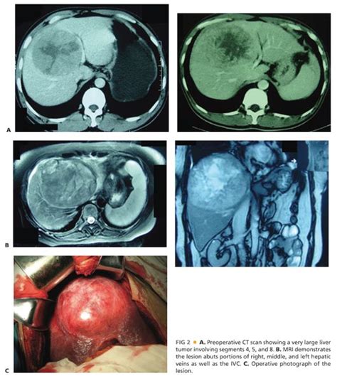 Central Hepatectomy Abdominal Key