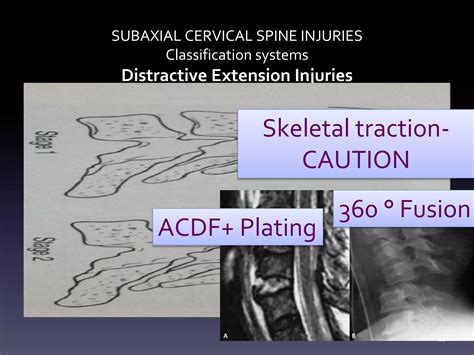 Subaxial Cervical Spine Injuries Pptx