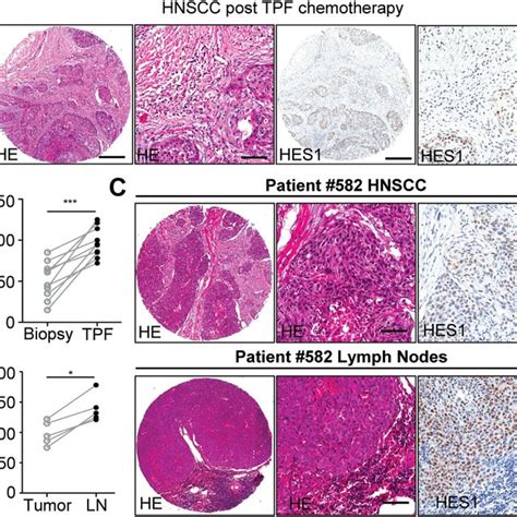 Notch Inhibition Reduces Chemoresistance Of Cal27 Cell Xenograft A