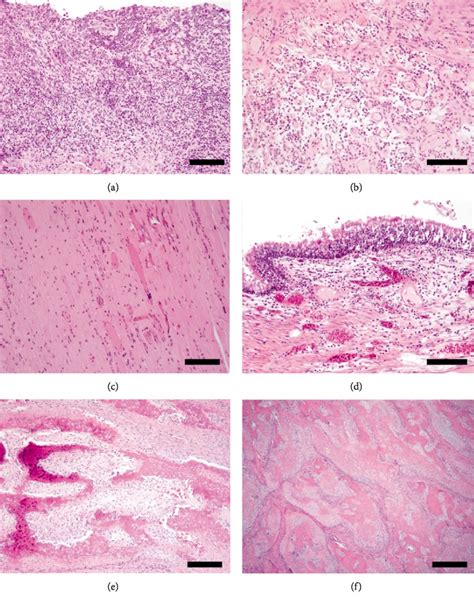 Single Stage Craniectomy And Cranioplasty For Multilobular Osteochondrosarcoma Managed With A