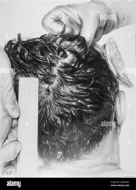 Drawing Depicting The Posterior Head Wound Of U S President John F