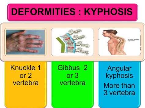 Potts Spine Tuberculosis Spine Pptx Ppt