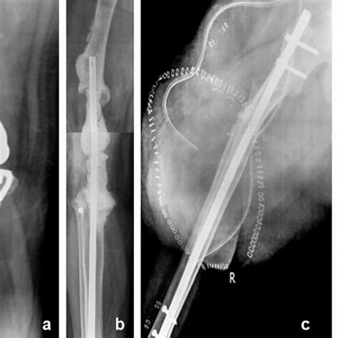 A Radiograph Of Failed Proximal Tibia Megaprosthesis With Limb Length