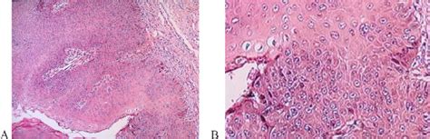 Multiple Pink Colored Papillomatous Papules And Plaques Involving Oral Download Scientific