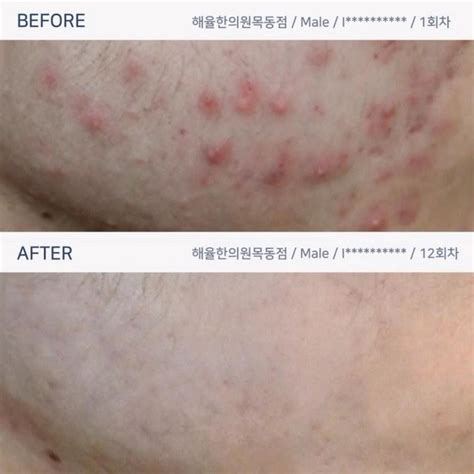 여드름은 해율한의원목동 여드름흉터모낭염모공각화증지루성피부염주사피부염 여드름피부여드름치료한의원케어 외부치료와 내부