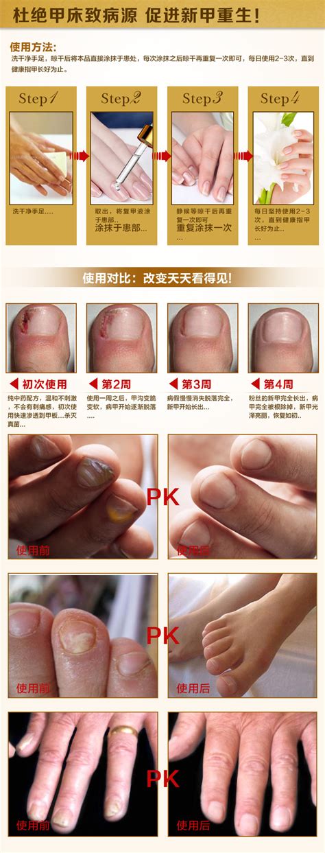 各种类型灰指甲图片 灰指甲的分类图片 灰指甲各个阶段图片 大山谷图库