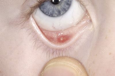 Cyst Chalazion On Eyelid Stock Image M Science Photo Library