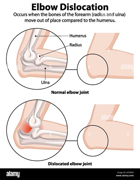 Comparison Of Normal And Dislocated Elbow Joints Stock Vector Image