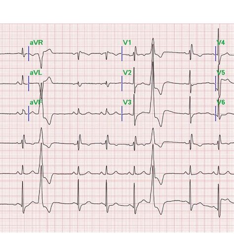 Integration Of Fixed Fluoroscopy Images Into The 3d Electroanatomical Download Scientific