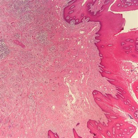 Infiltrative Cell Nests Ductal And Glandular Structures In The