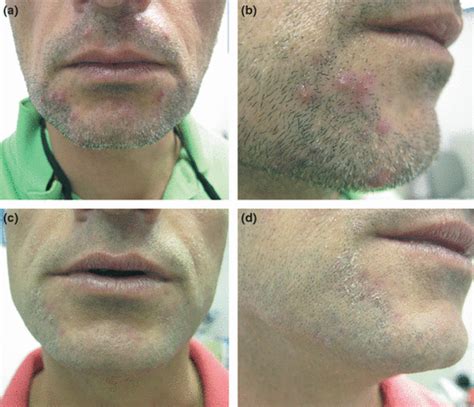 Cutaneous Candidiasis Face