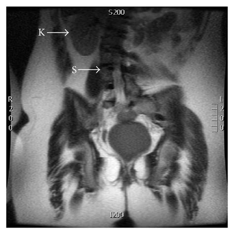 Management Of Recurrent Stricture Formation After Transverse Vaginal Septum Excision Abstract