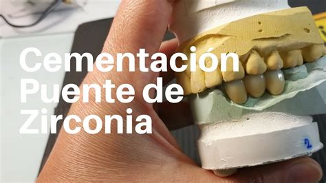 PUENTE De ZIRCONIA Posterior CEMENTACION Puentezirconia Puentedental YouTube