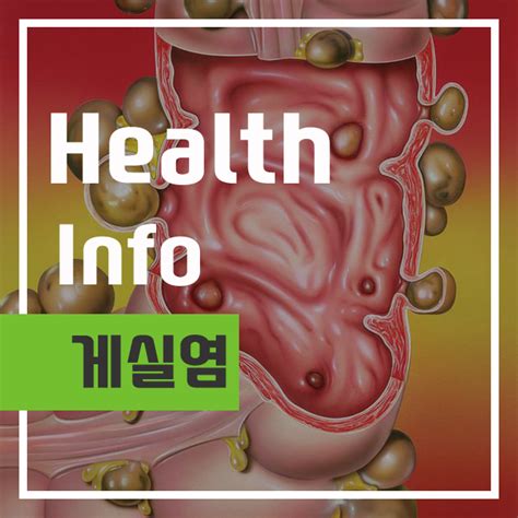 대장 게실염 증상 및 원인 치료 네이버 블로그
