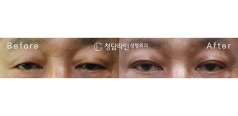 상안검 하안검 전후사진 청담라인성형외과