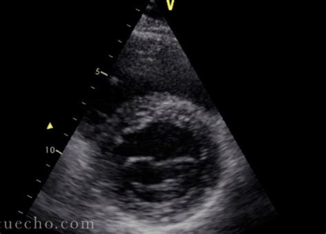 Mitral Valve Anatomy On Echo Diagram Quizlet