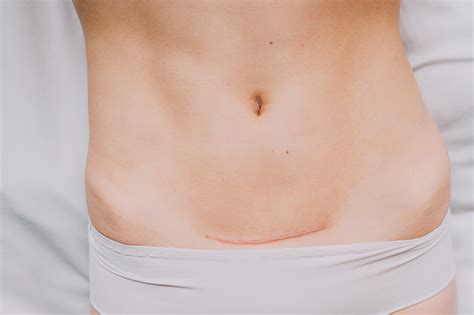 Why We Should Pay Attention To C Section Scars Katie Kelly