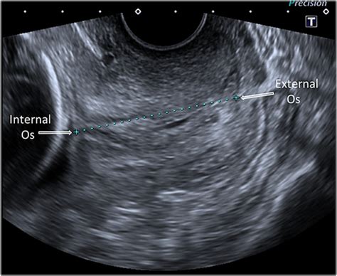 The Maternal Cervix Why When And How Ohara 2015 Sonography
