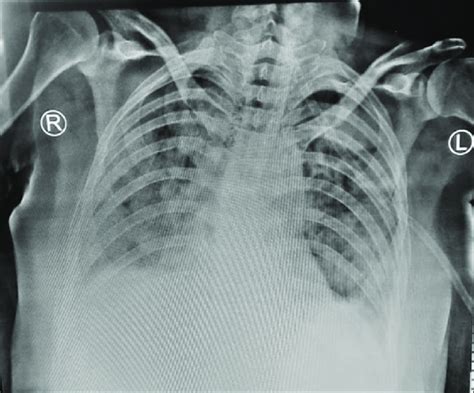 Chest X Ray Findings Confirmed Download Scientific Diagram