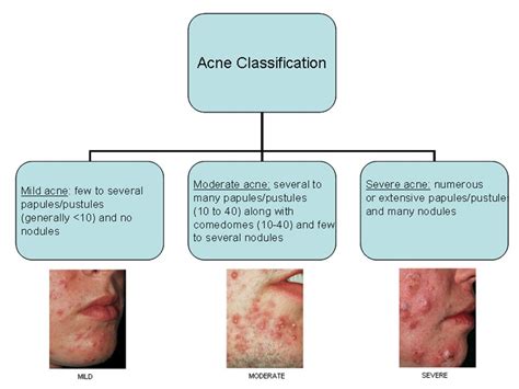 Acne Vulgaris Nurses Revision