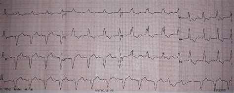 12 lead ecg showing mbbb precordial type rbbb in right precordial